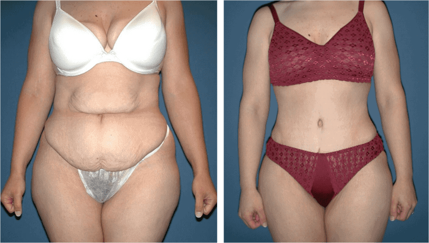abdominal implants turkey
