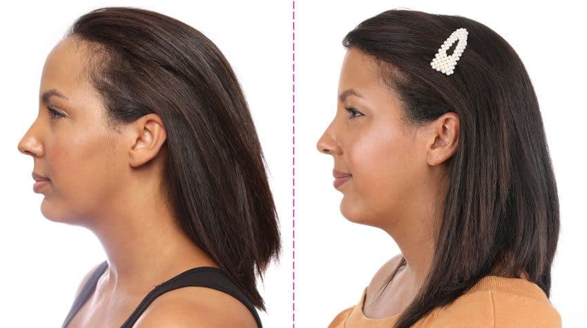 forehead reduction turkey