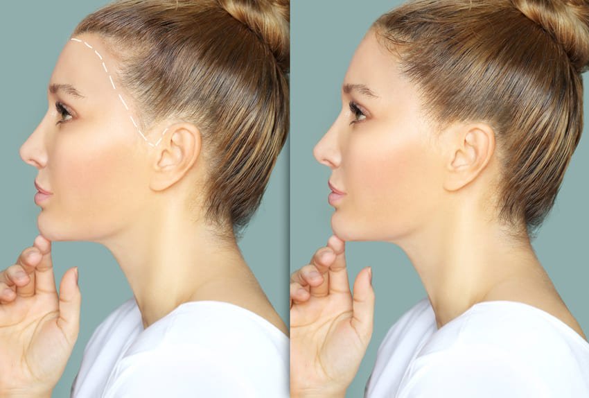 forehead reduction turkey