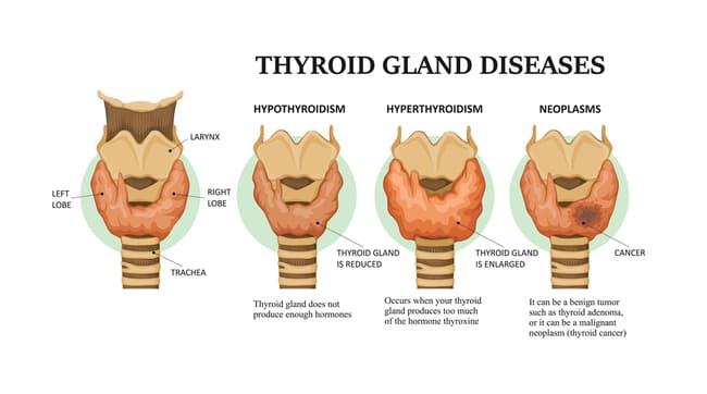 thyroid glandular uk